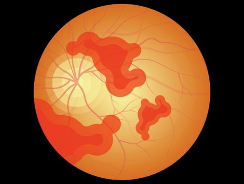 Ophthalmologist Bonita Springs | Retina Specialist Naples